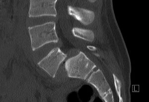 Spondylolyse und Spondylolisthese der Lendenwirbelsäule - Dr. Biren ...